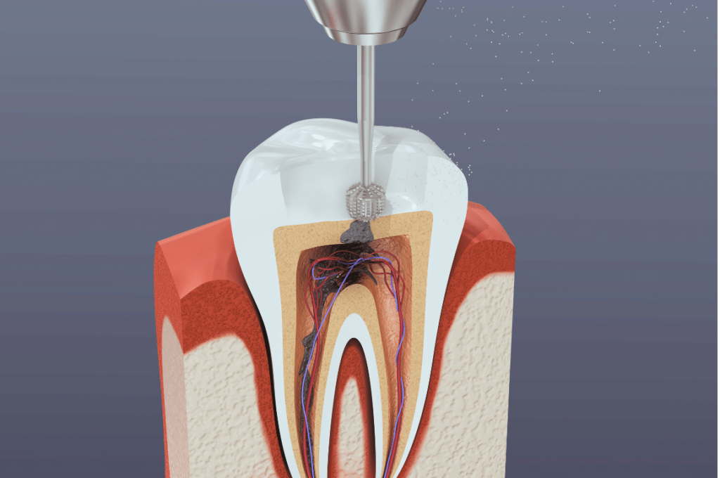 Endodontics Treatment in Fredericksburg & Ashland | Smile Center